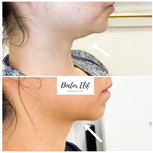 Fat Dissolving Injections at Dr. Elif Clinic in London