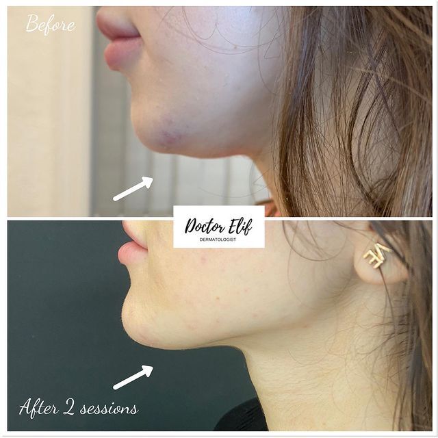 Fat Dissolving Injections | Dr. Elif Clinic | Double chin Removal