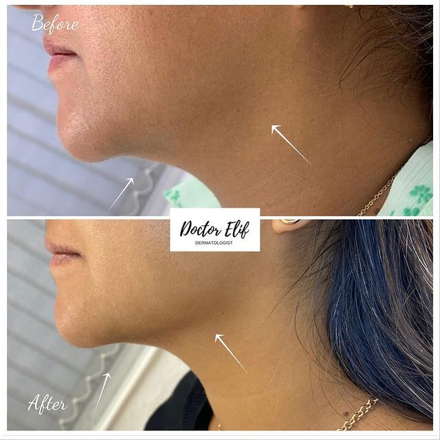 Fat Dissolving Injections | Dr. Elif Clinic | Double chin Removal