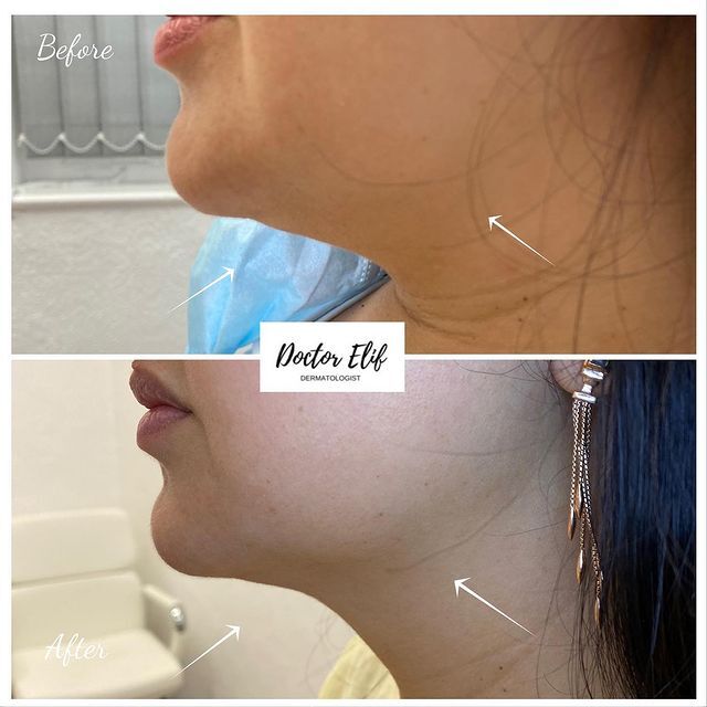 Fat Dissolving Injections at Dr. Elif Clinic in London