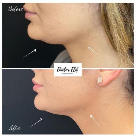 Fat Dissolving Injections at Dr. Elif Clinic in London