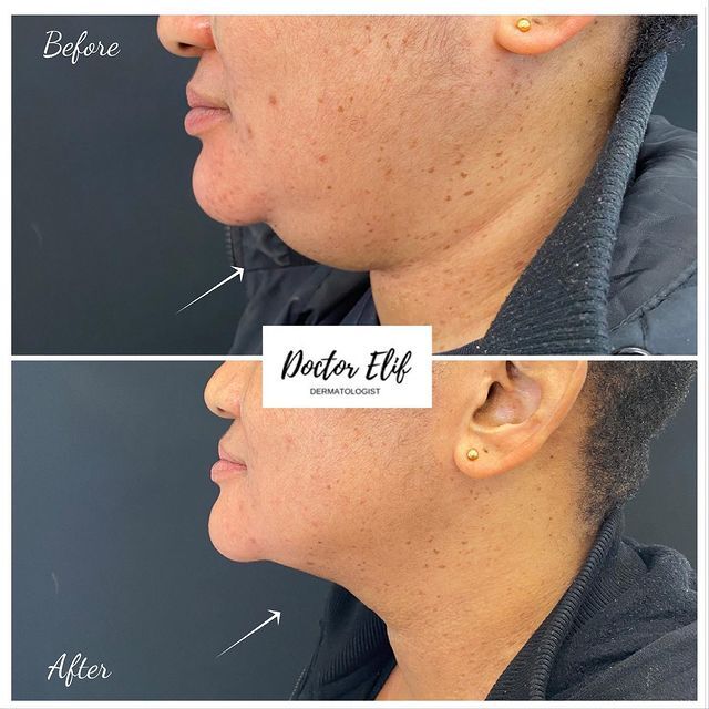 Fat Dissolving Injections | Dr. Elif Clinic | Double chin Removal