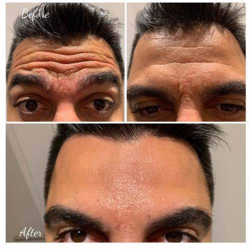 Forehead / Frown Lines / Crows Feet – Dr. Elif Clinic