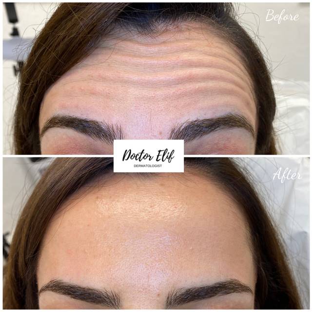 Forehead / Frown Lines / Crows Feet – Dr. Elif Clinic
