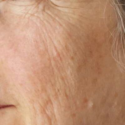 Tixel Treatment | skin resurfacing, fine wrinkles, skin tightening ...