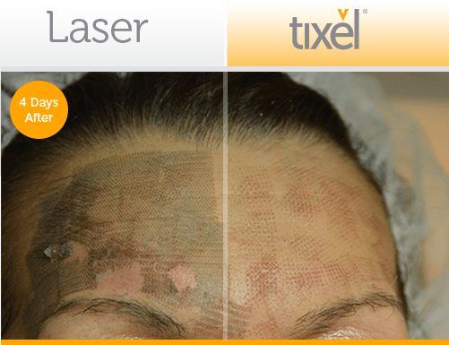 Tixel Treatment | skin resurfacing, fine wrinkles, skin tightening ...