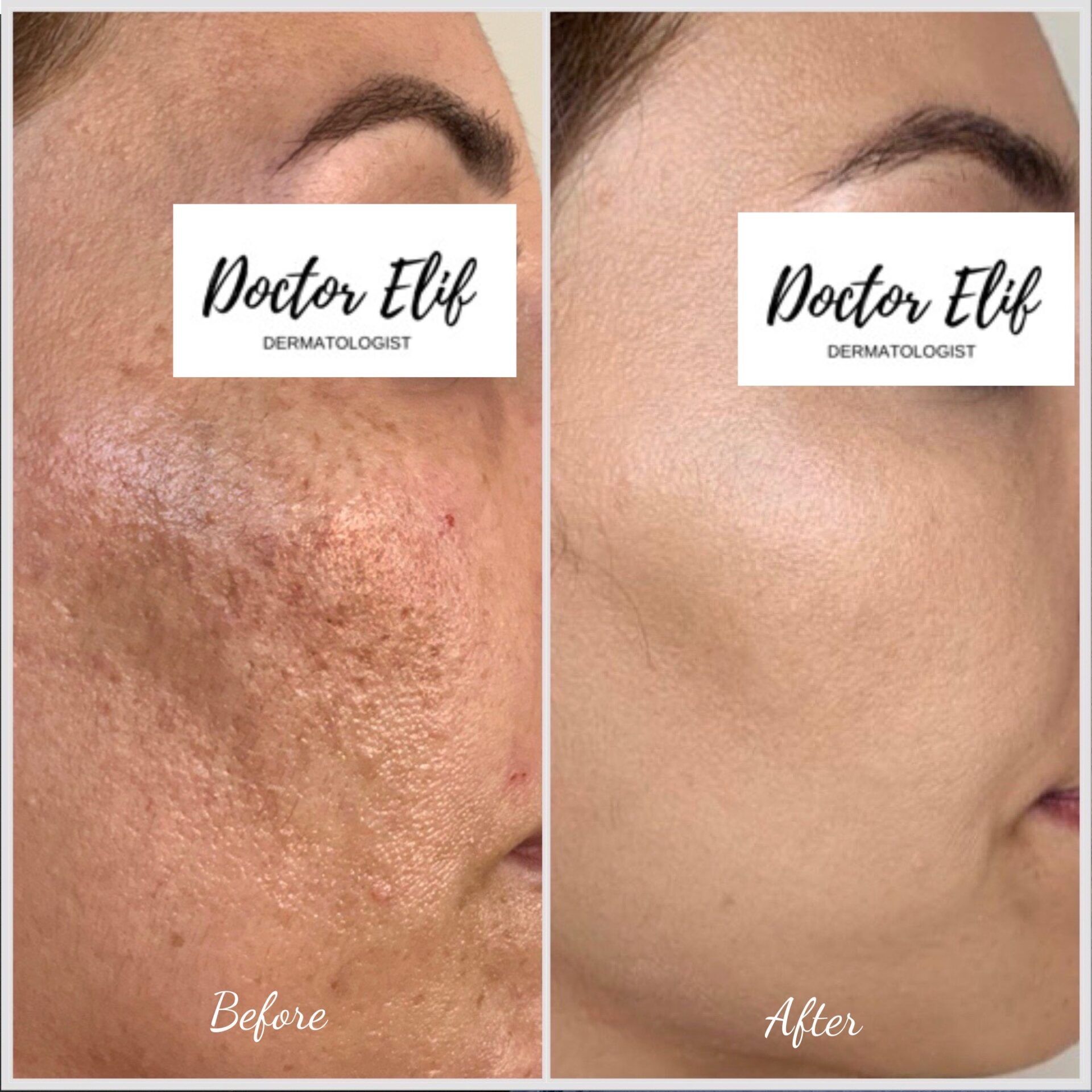 Acne Scar Treatment | Dr. Elif Clinic