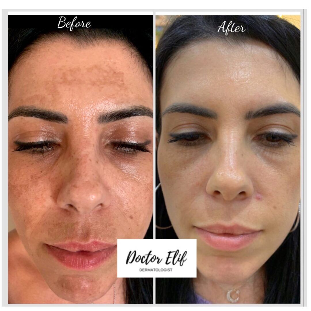 Melasma Hyperpigmentation Treatment – Dr. Elif Clinic