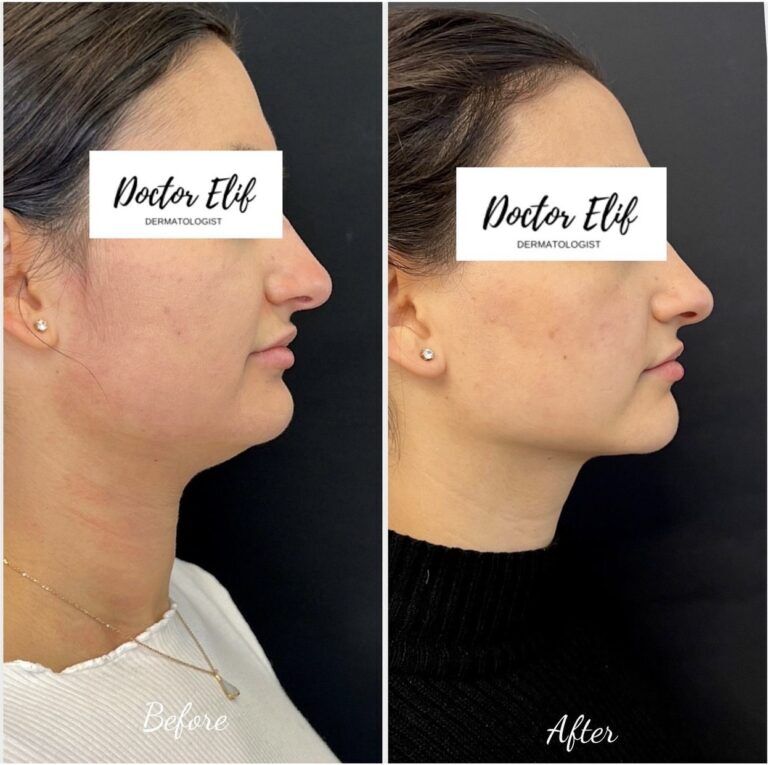 Fat Dissolving Injections | Dr. Elif Clinic | Double chin Removal