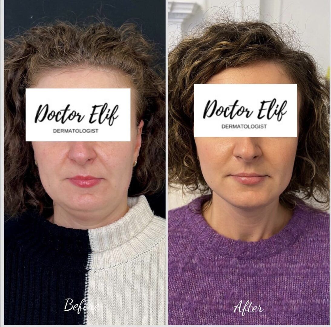 Fat Dissolving Injections | Dr. Elif Clinic | Double chin Removal