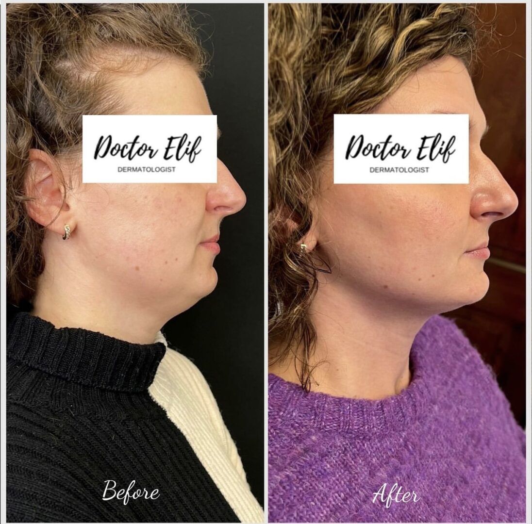 Fat Dissolving Injections at Dr. Elif Clinic in London