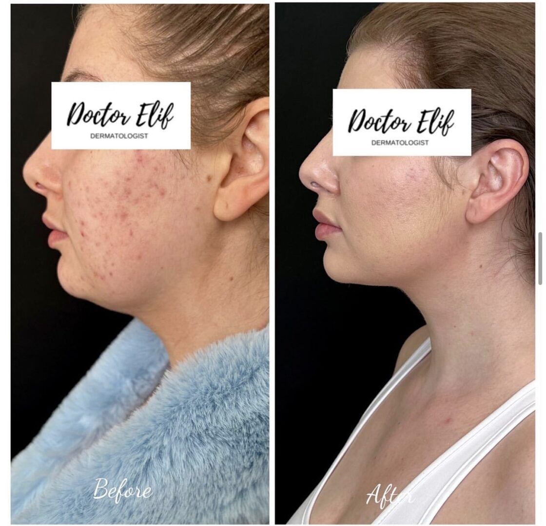 Fat Dissolving Injections at Dr. Elif Clinic in London