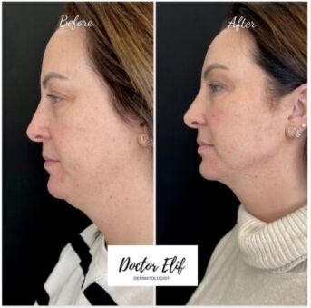 Fat Dissolving Injections | Dr. Elif Clinic | Double chin Removal