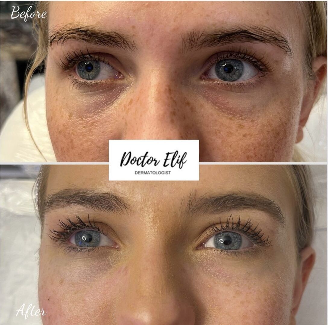 Polynucleotide Treatment | Dr. Elif Clinic