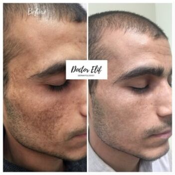 hyperpigmentation patient uk