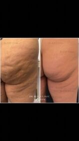 is cellulite normal