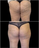 is cellulite normal